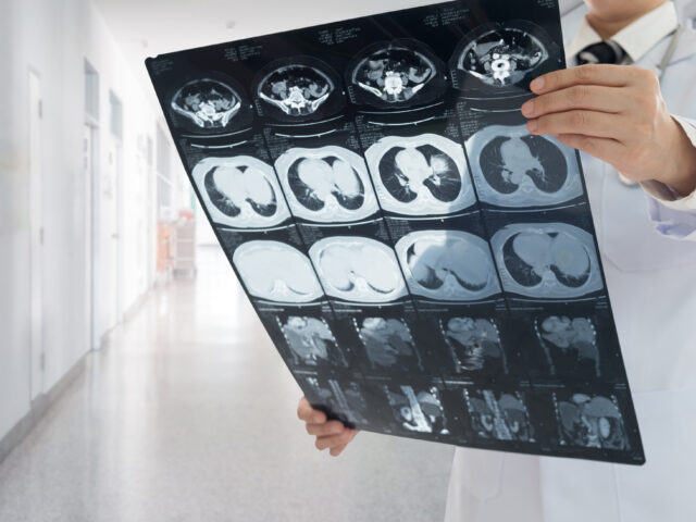MASH/MASLD Imaging | Medpace