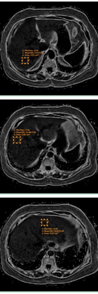 MASH/MASLD Imaging | Medpace
